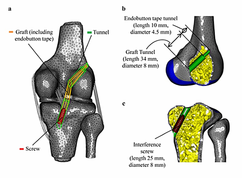 Orion - Anterior Cruciate Ligament (ACL) reconstruction