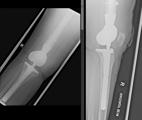 Megaprosthesis Total Knee Replacement For Periprosthetic Fracture