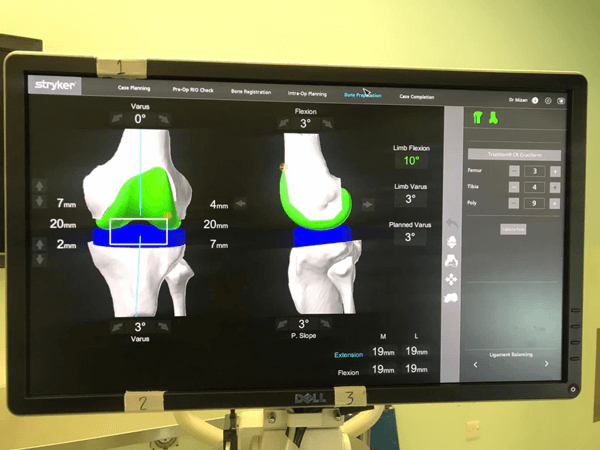Patient’s Guide To MAKOplasty® Robotic Knee Replacement