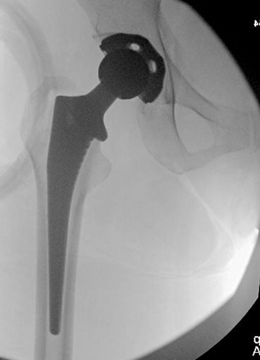 Total Hip Replacement Surgery | Direct Anterior Approach (DAA) | Orion