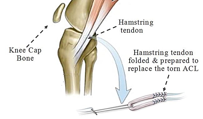 Orion - Anterior Cruciate Ligament (ACL) reconstruction