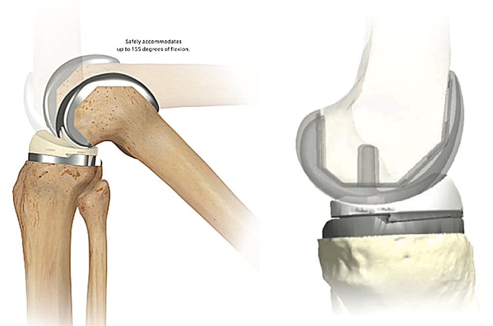 Knee Replacements In Singapore: What You Need To Know