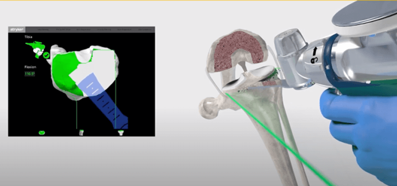 Patient’s Guide To MAKOplasty® Robotic Knee Replacement
