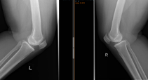 Bilateral Unicompartmental/Partial Knee Replacement (UKA)