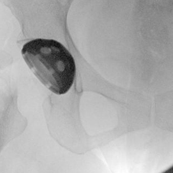 Total Hip Replacement Surgery | Direct Anterior Approach (DAA) | Orion