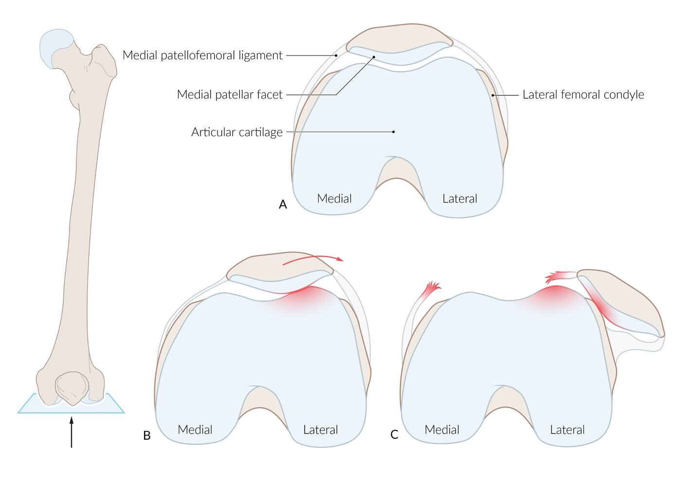 Do You Have a Patella Instability?