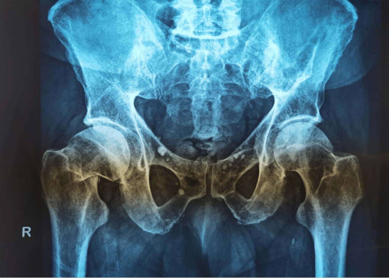 Orion - Hip Fractures