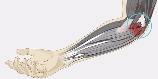 Common Golfing Injuries | Orion Orthopaedic Surgery