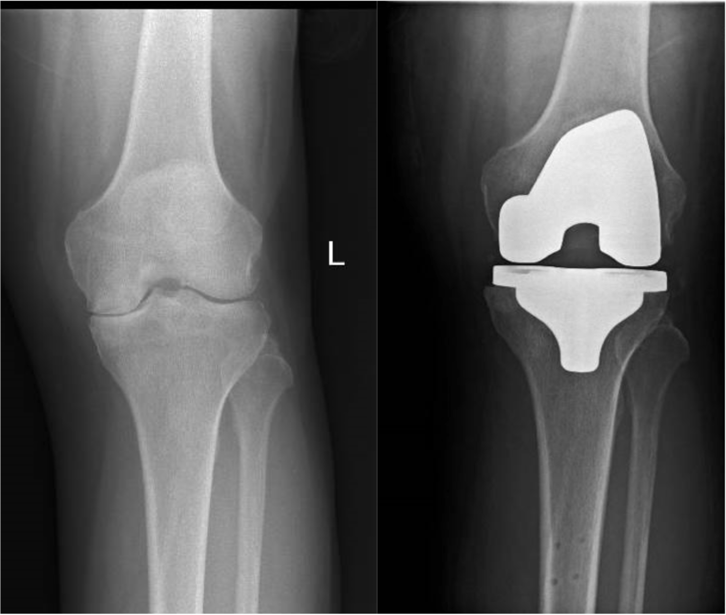 Robot-Assisted Mako Total Knee Replacement