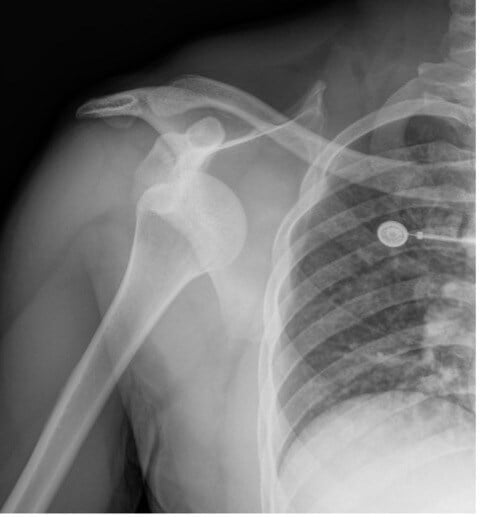 Shoulder Dislocations | Orion Orthopaedic Surgery