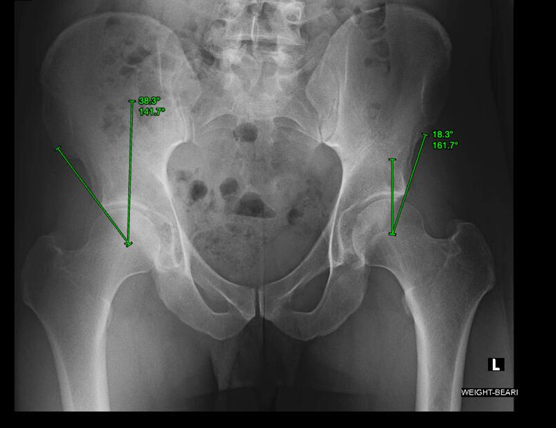 Hip Labral Tears | Orion Orthopaedic