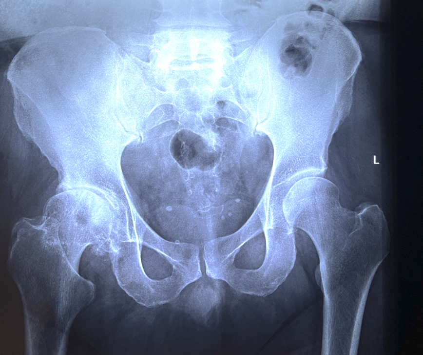 Hip Labral Tears | Orion Orthopaedic