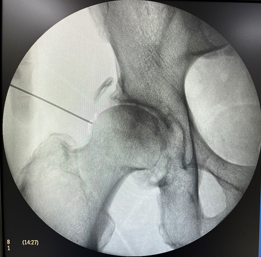 Hip Labral Tears | Orion Orthopaedic