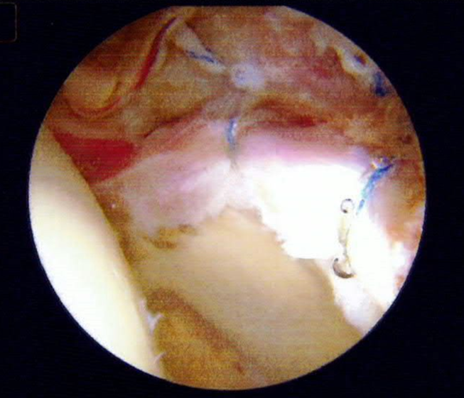 Hip Labral Tears | Orion Orthopaedic