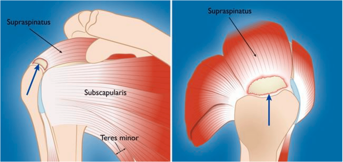 Rotator Cuff Conditions | Orion Orthopaedic Surgery