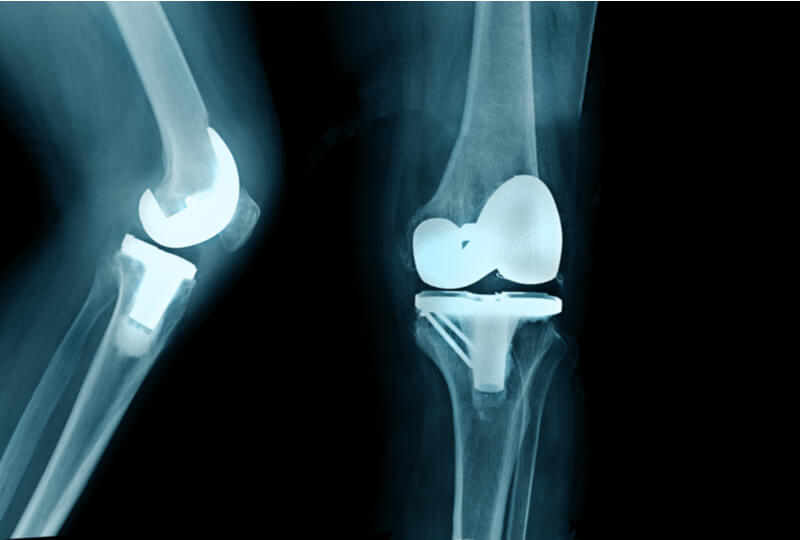 Megaprosthesis Total Knee Replacement For Periprosthetic Fracture