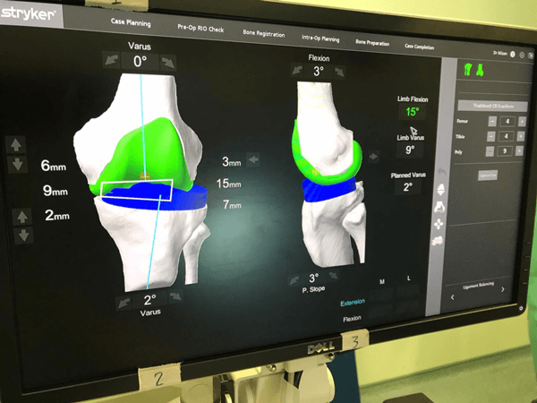 Patient’s Guide To MAKOplasty® Robotic Knee Replacement
