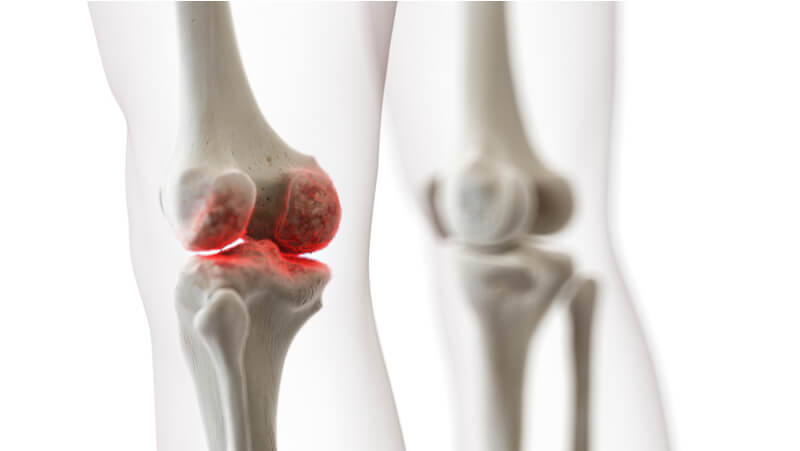 Severe Knee Infection: To Amputate Or Preserve The Leg?